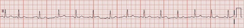 EKG Rhythm Strip Quiz 51: Sinus Rhythms