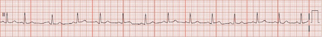 EKG Rhythm Strip Quiz 51: Sinus Rhythms