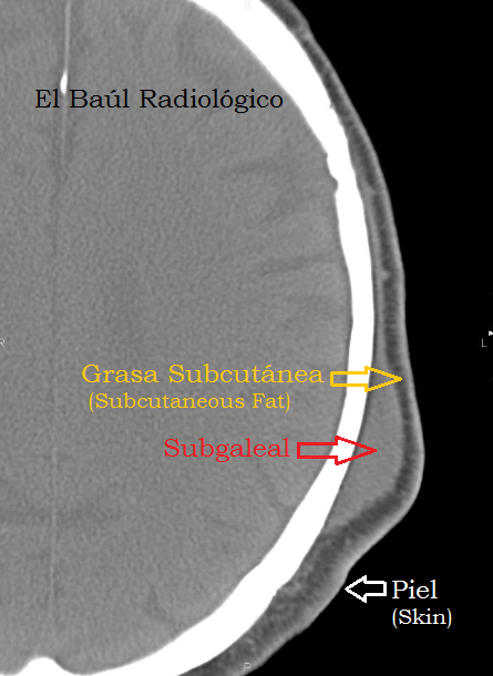 El Baúl Radiológico: 2) HEMATOMA SUBGALEAL: HALLAZGOS EN TOMOGRAFÍA ...