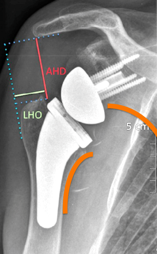 UW Shoulder and Elbow Academy: Reverse total shoulder lengthens the arm ...