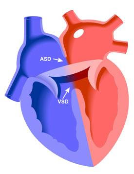 Phimaimedicine: 1,757 Atrioventricular septal defect in Down syndrome
