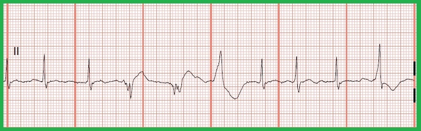ECG Rhythm Strip Quiz 95 Ventricular ectopy