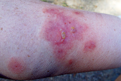 Big Pine: SPIDER BITE