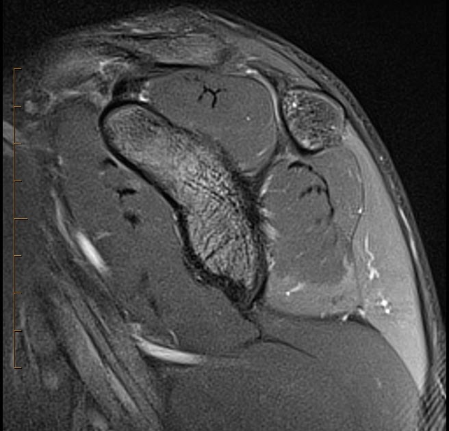 Quadrilateral Space Syndrome Wikidoc