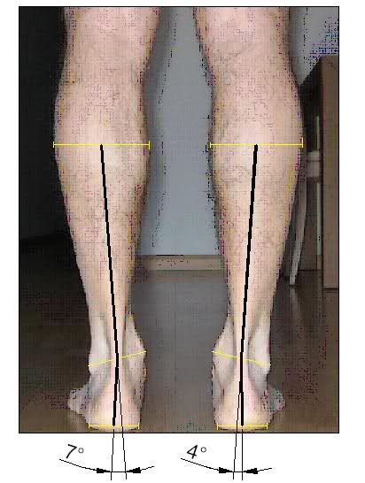 MAGIC FEET: Origen de las lesiones deportivas