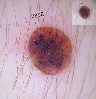 DERMATOSKOPİ ve TRİKOSKOPİ: WOBBLE İŞARETİ