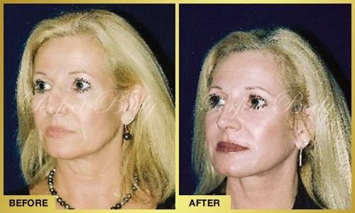 Perfect Body Laser and Aesthetics: Non-Surgical Neck Lift