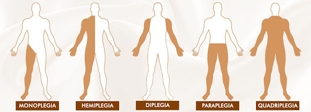 Treatment for Paralysis: What is Paralysis?