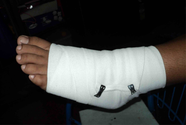 Tidak Nyaman Dengan Keseleo yang Menyiksa?? Jangan Dipijat atau Diurut ...