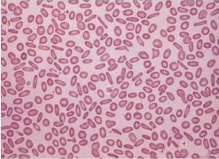 FICHERO DE HEMATOLOGIA: ELIPTOCITOS