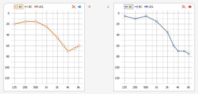 Sonora Centro Auditivo: O que é um Audiograma?