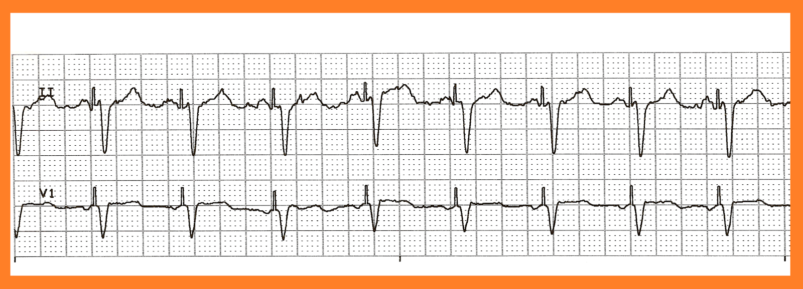 Various Ventricular Paced Rhythms