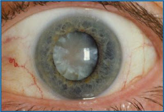 Cataract+Eye.jpg