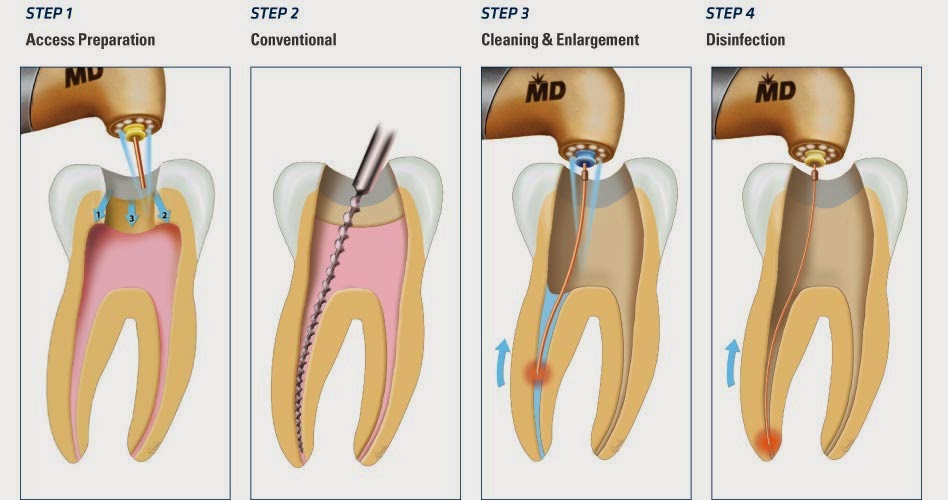 Dr. Cecilia Lontoc, DMD: What is Root Canal