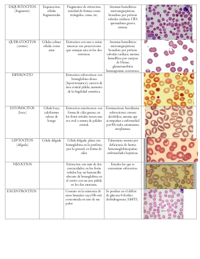 Laboratorista Clínico Majos: Anormalidades de los eritrocitos