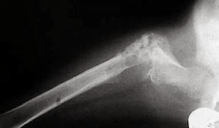 Figura 2. Varón de 10 años de edad. Sarcoma de Ewing a nivel de 1/3 ...