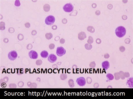 Lab Atlas: Acute Plasmocytic Leukemia