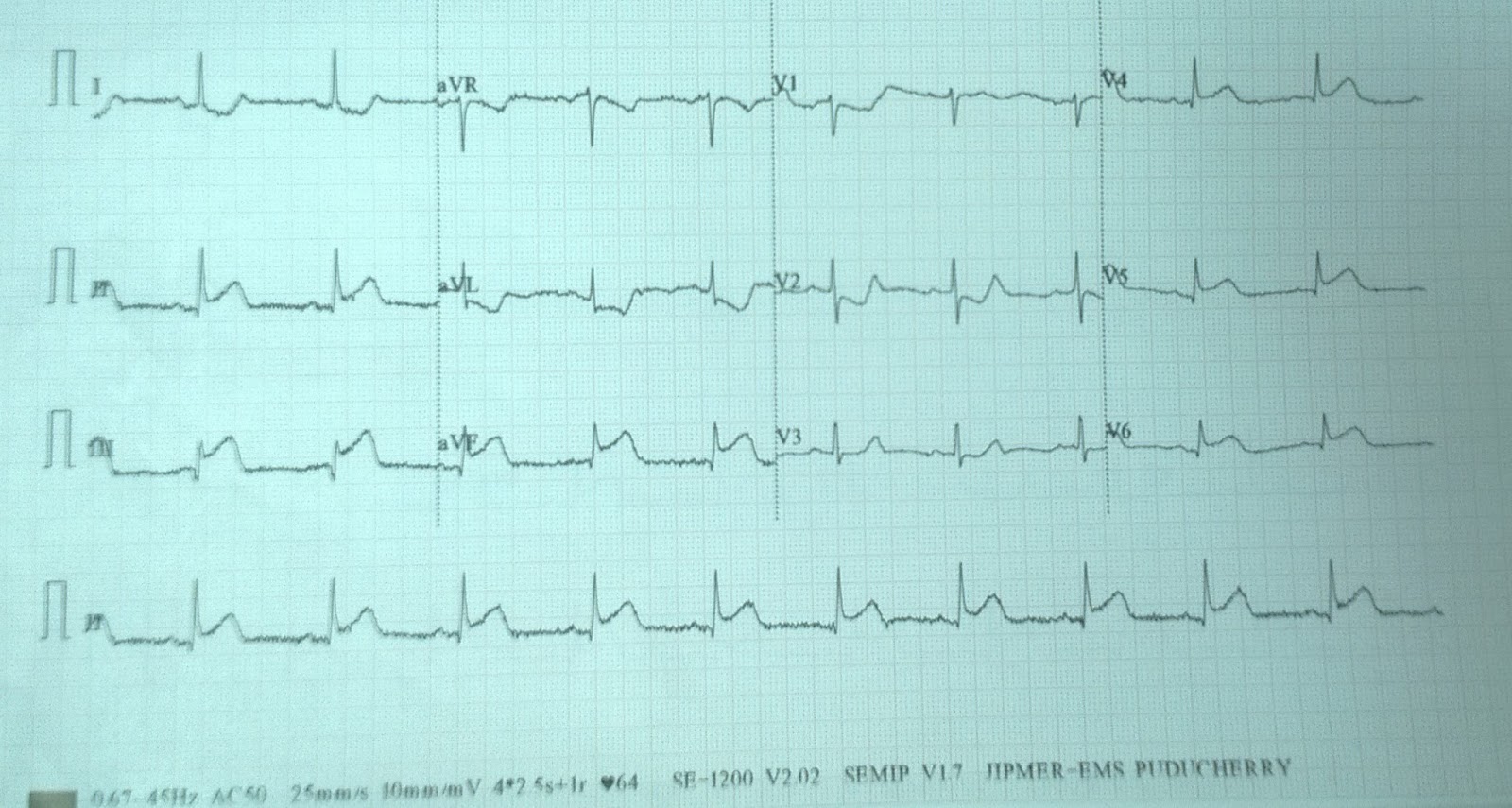 Cardiology window: Inferior wall with posterior wall with right wall ...