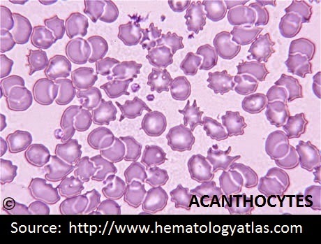 Lab Atlas: Acanthocytes