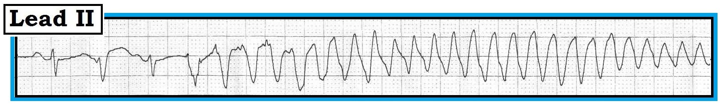 ECG Interpretation: ECG Interpretation Review #36: (WCT - VT - A Fib ...