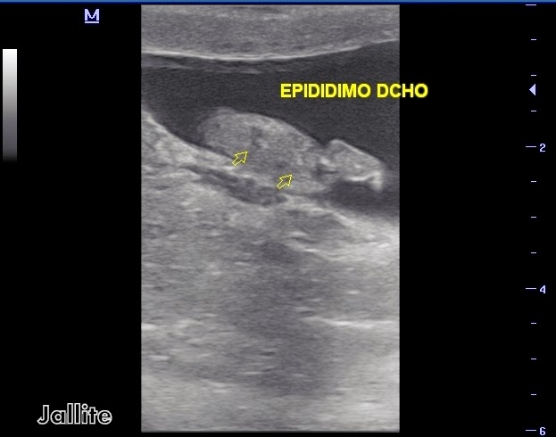 Hernia Inguino-Escrotal Derecha & Hernia Inguinal Izquierda