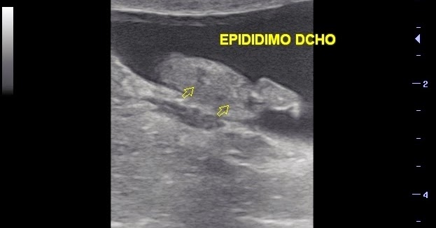 Hernia Inguino-Escrotal Derecha & Hernia Inguinal Izquierda