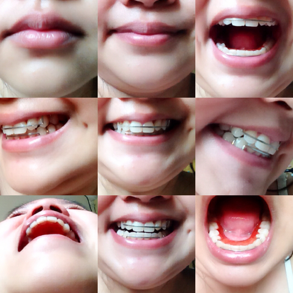 Pasang Kawat Gigi alias Behel (2) - Passion is Love