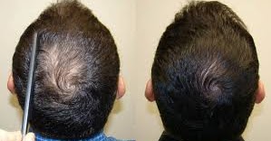 Best Hair Transplant: Restore your Young Look with Crown Hair Transplant