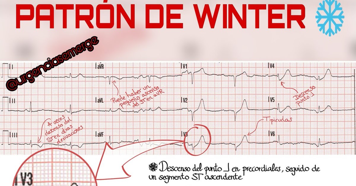 ZONA DE SALUD DE OFRA: Patrón de Winter.