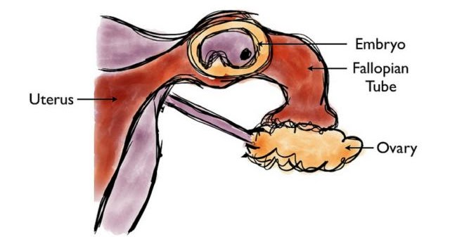 Apa itu Kehamilan Ektopik dan Bagaimana Cara Mengetahuinya?