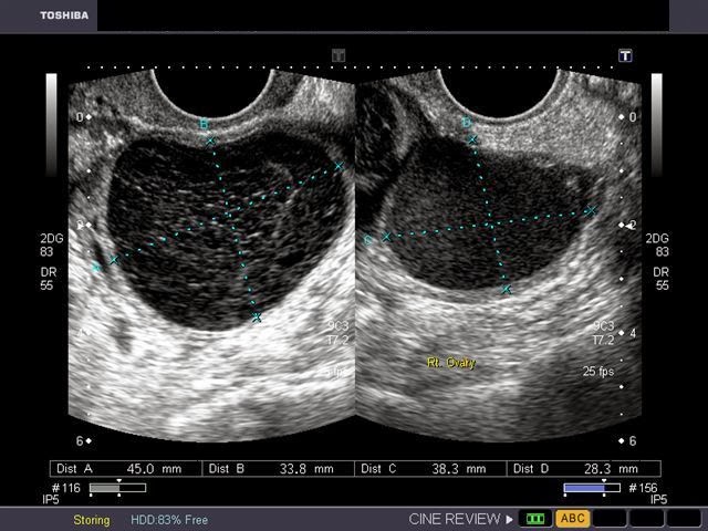 Klinik Dr Zaharuddin KL Gynaecologist: SISTA OVARI (OVARIAN CYST)
