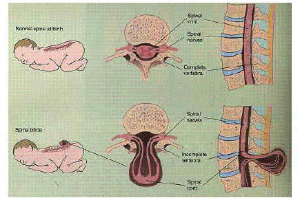 Espinha bífida oculta; Sinus Dérmico; Espinha Bífida Fechada