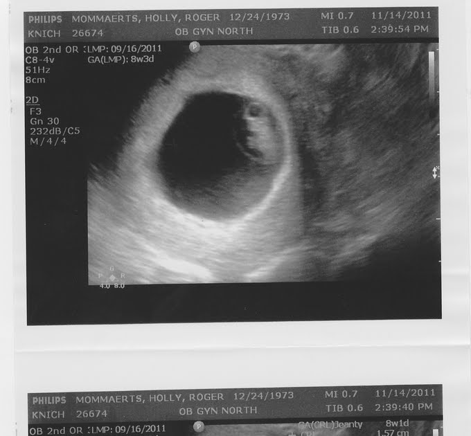 mommaerts :: blog: Four Ultrasounds In One Week