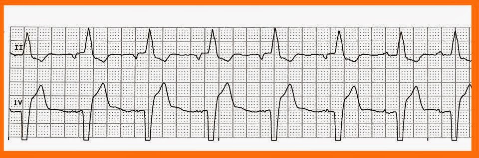 Various Accelerated Junctional Rhythms