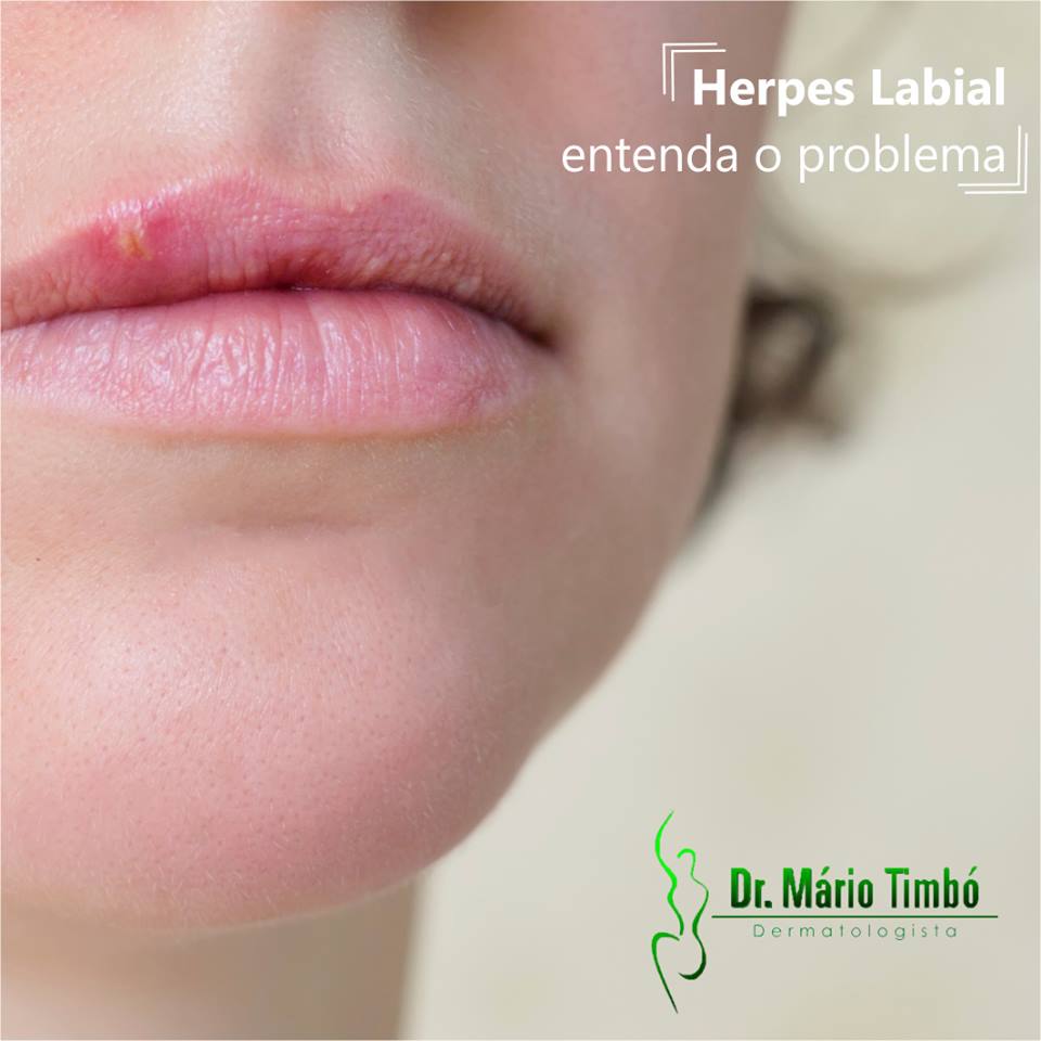 BLOG ENCONTRO COM A SAÚDE DE SOBRAL: Sobre herpes labial - Dr. Mário ...