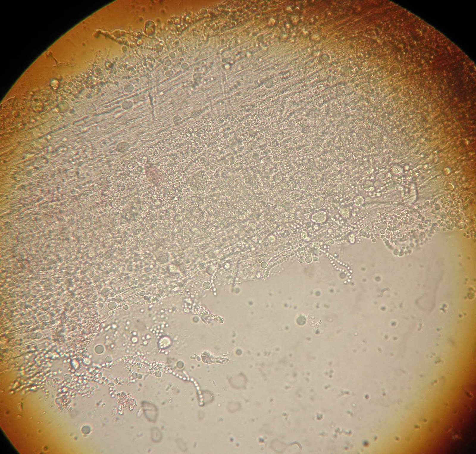 ATLAS MICOLOGIA: SICOSE POR TRICHOPHYTON MENTAGROPHYTES