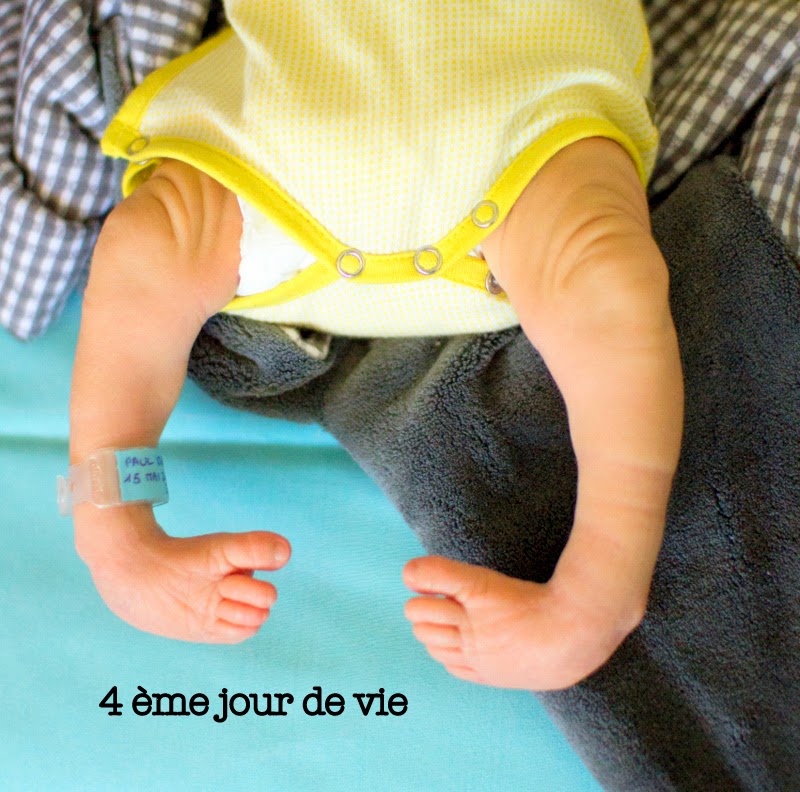 Pieds Bots Varus Equin Idiopathique: Ses premiers plâtres