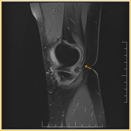 Posteromedial Corner Injury-MRI - Sumer's Radiology Blog