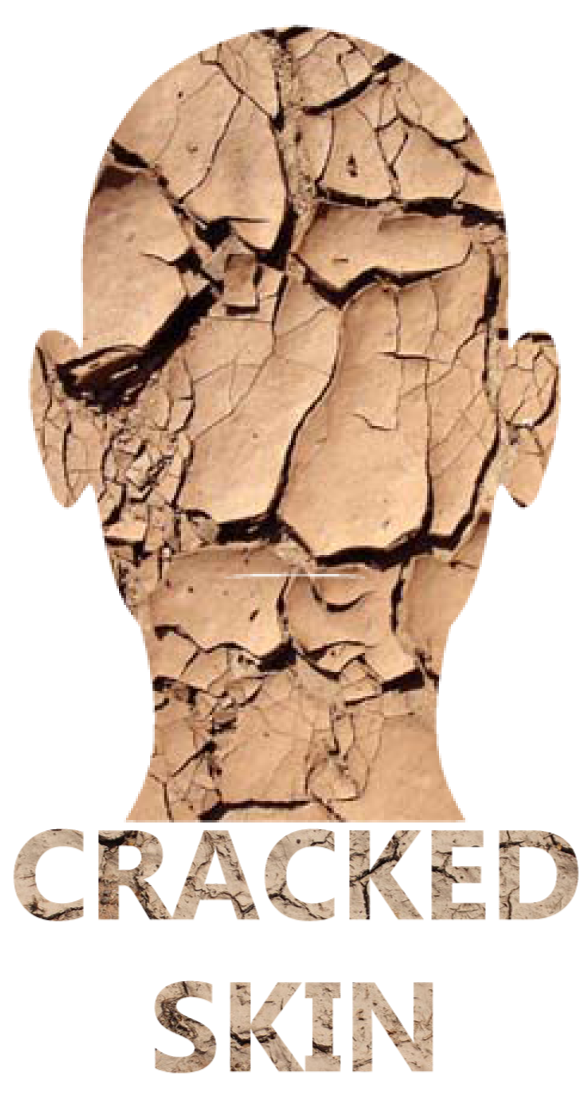 NextGDesign: CRACKED SKIN: CAUSES & REMEDIES
