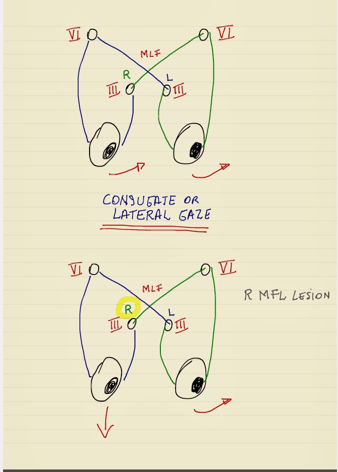 Quike & Vivi's World: Conjugate or Lateral Gaze