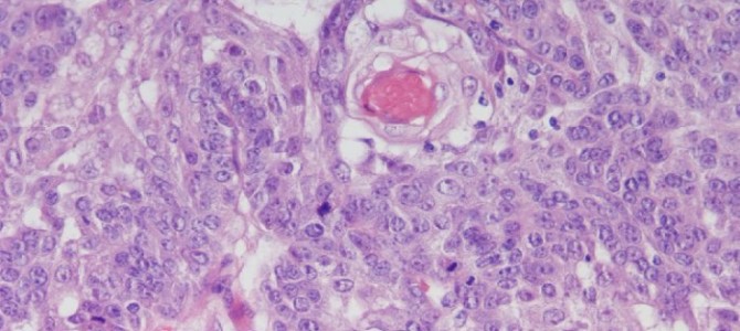 Sebaceous carcinoma of the skin of the breast: a case report ~ Canadian ...