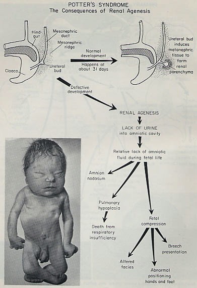 USMLE COMLEX Study Guides : First Aid Renal Embryology