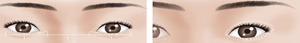 [Eye & Eyelid] Canthoplasty eyelid surgery for beautiful eyes