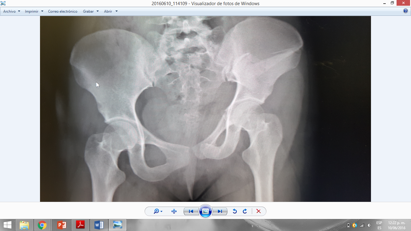 O R T O C R I T I C A: FRACTURA DE PELVIS