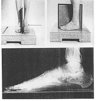 Teknik Radiograf: TEKNIK RADIOGRAFI OS PEDIS