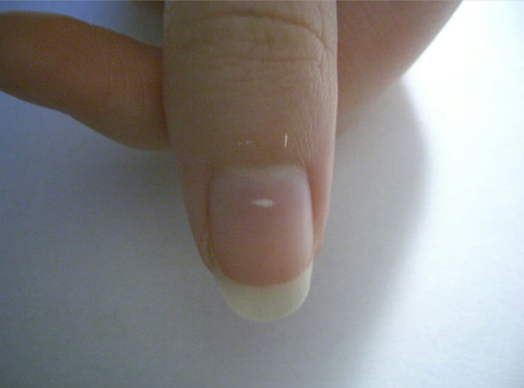 White Spots on Fingernails Indicate Calcium deficiency. - Fact or Myth ...