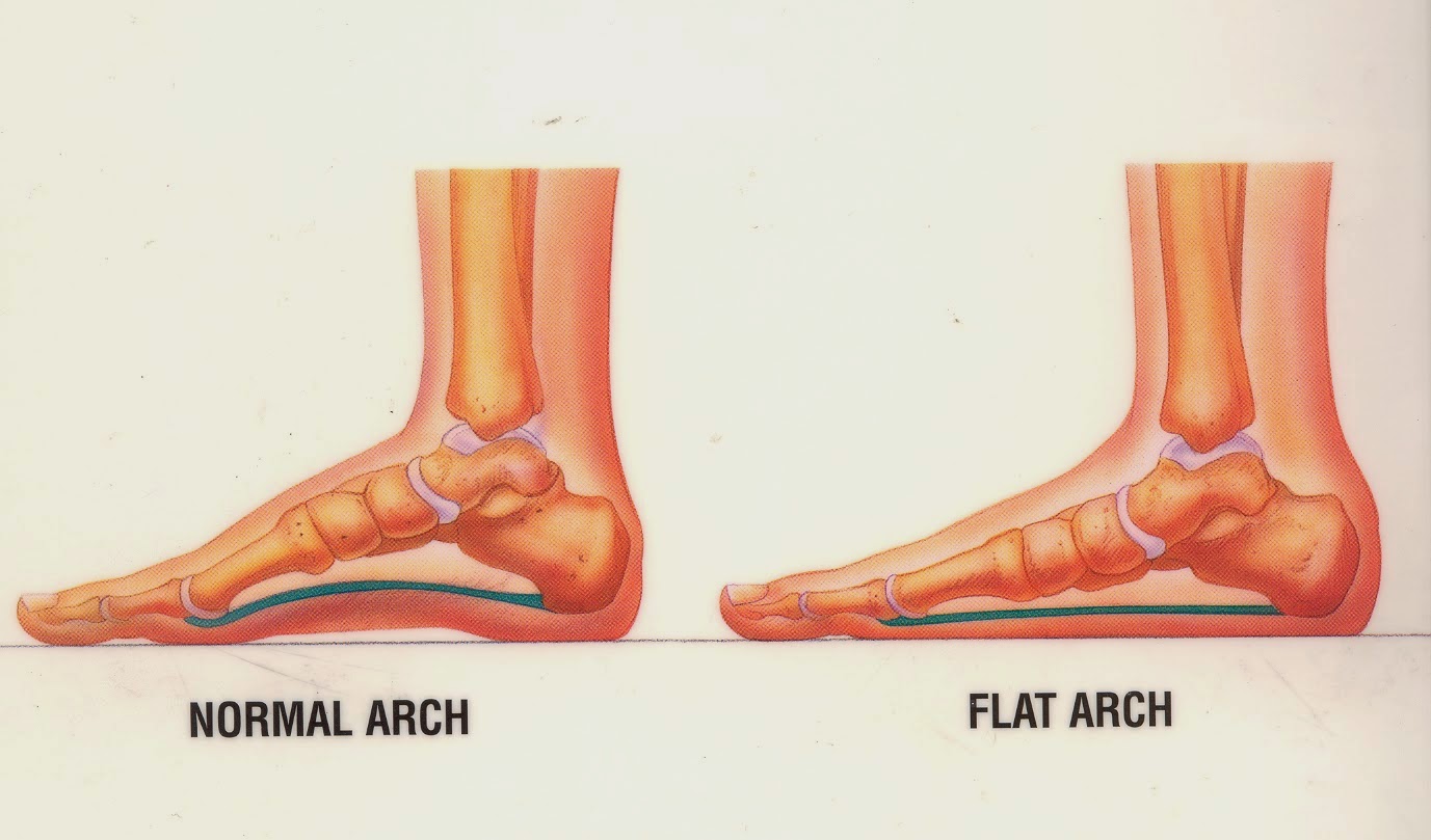 Medische Kennis: Platvoet (Pes Planus)