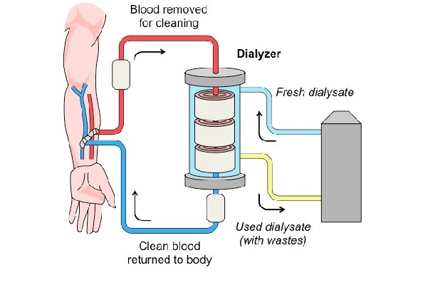 डालिसिस(Dialysis) क्या है?