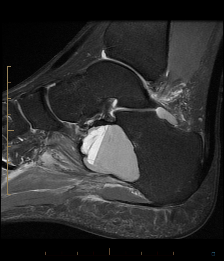 Radiology Cases: Unicameral Bone Cyst