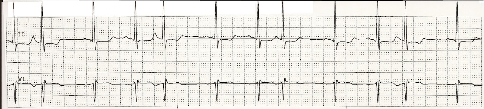 EKG Rhythm Strips 38